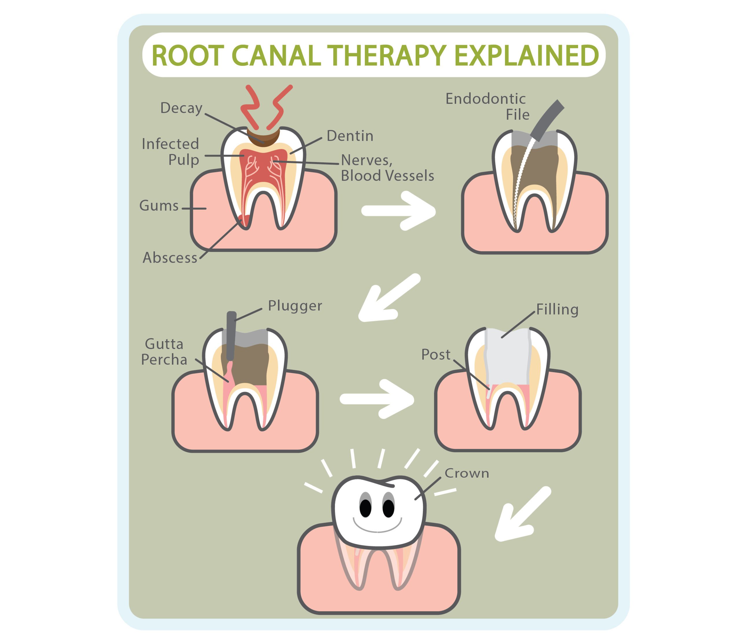 Our Calgary Dentist Gets to the Root of Root Canals. - Advance Your ...