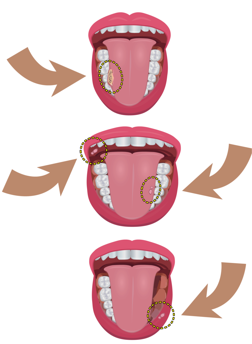 Calgary Dental Oral Cancer Screening - Advance Your Health Dental - Dr ...
